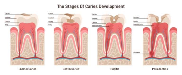 Tooth Nerve Pain: Causes And Treatments