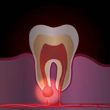 Tooth Nerve Pain: Causes And Treatments